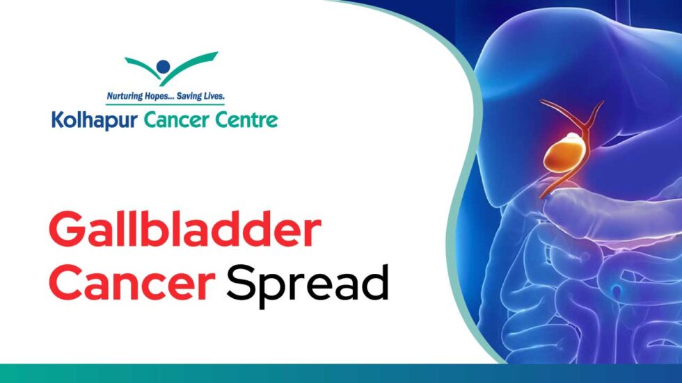 How Quickly Does Gallbladder Cancer Spread? - Kolhapur Cancer Centre